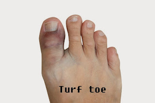 Tennis Turf Toe & Tennis Toe | Tennis Method